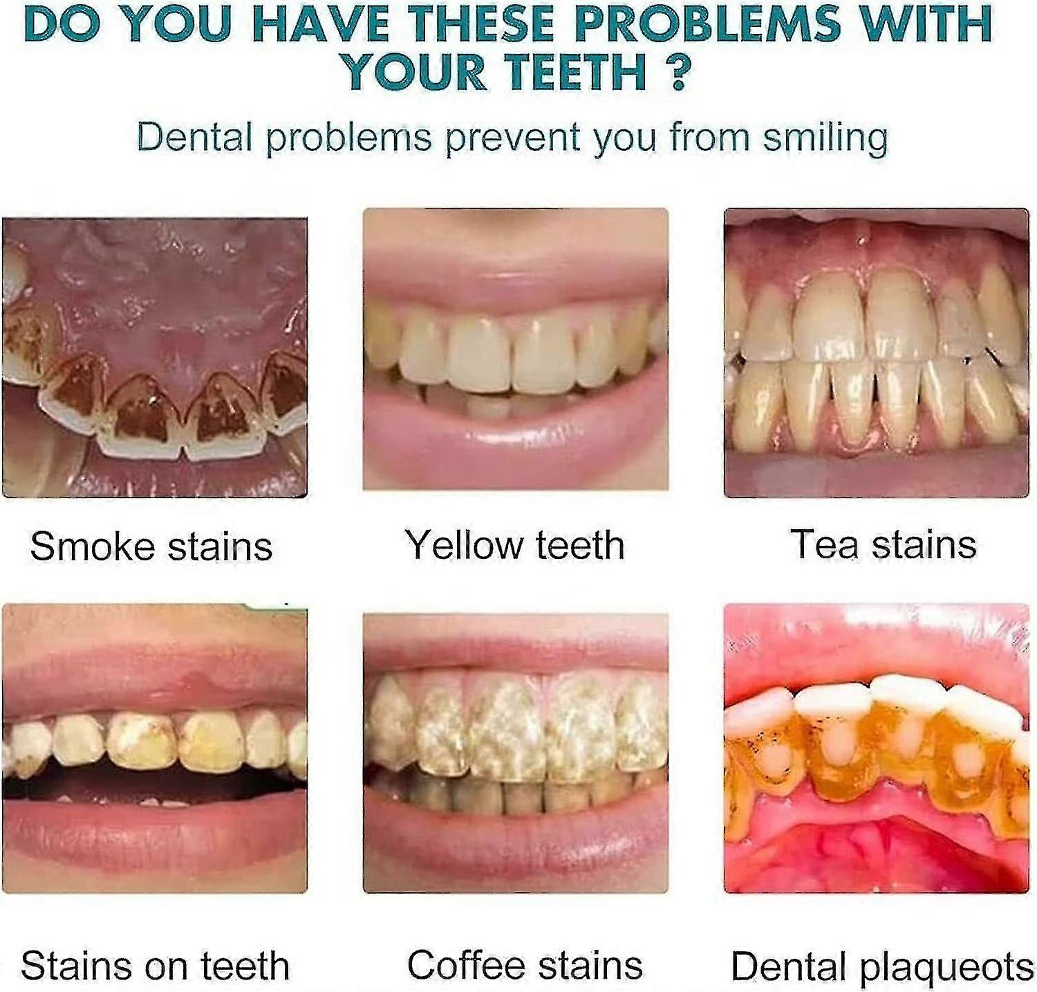 Tooth Paint, Teeth Whitening Gel, Instant Whitening Paint For Teeth ...