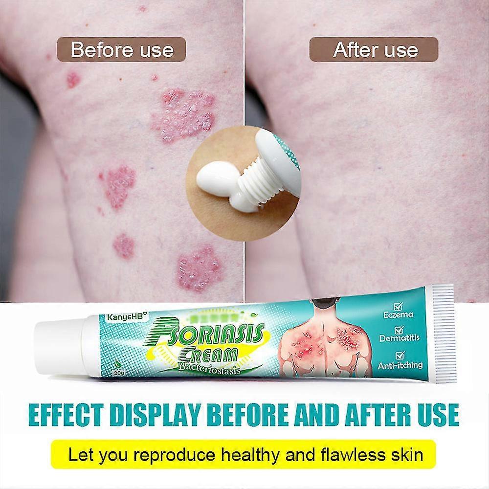 1/2stk Hud Ringorm Anti-itng Cream Dermatitis Eksem Psoriasis og 20g ...