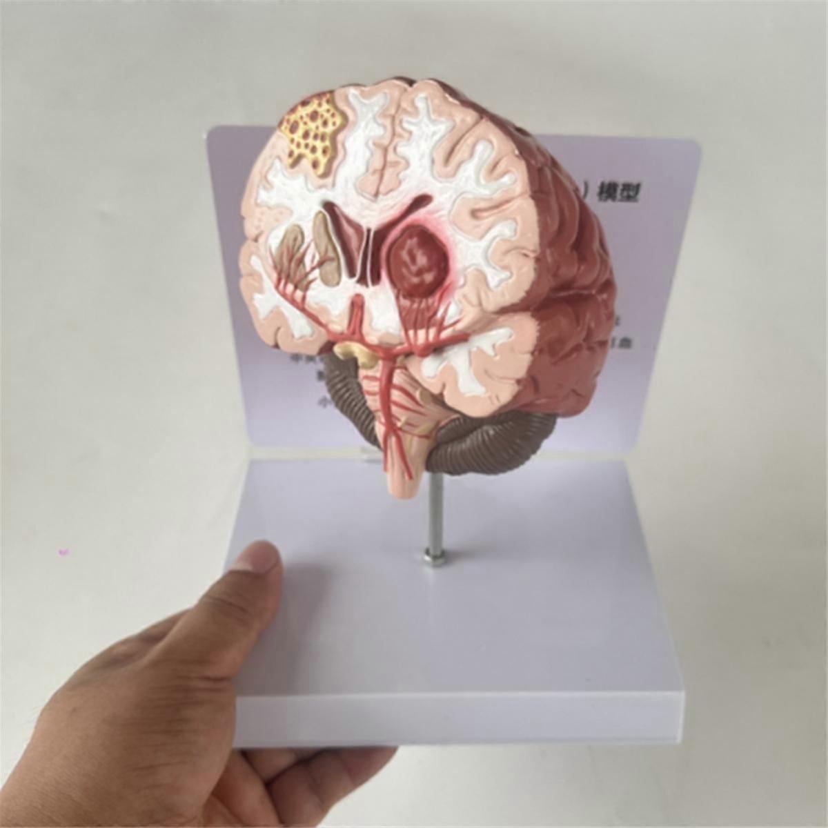 Human Brain Disease Model - Brain Pathology Brainstem Hemorrhage ...