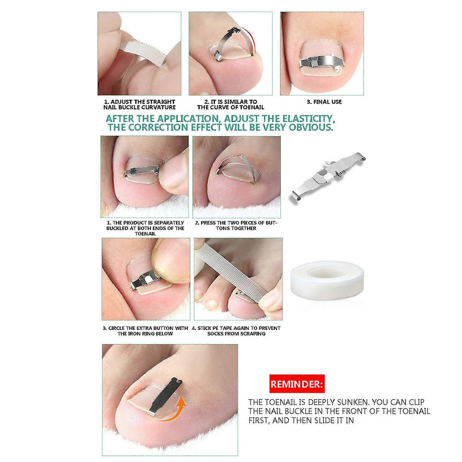 Orthopedic Buckle Nail Groove Ingrown Nail Orthosis Toenail Curling ...