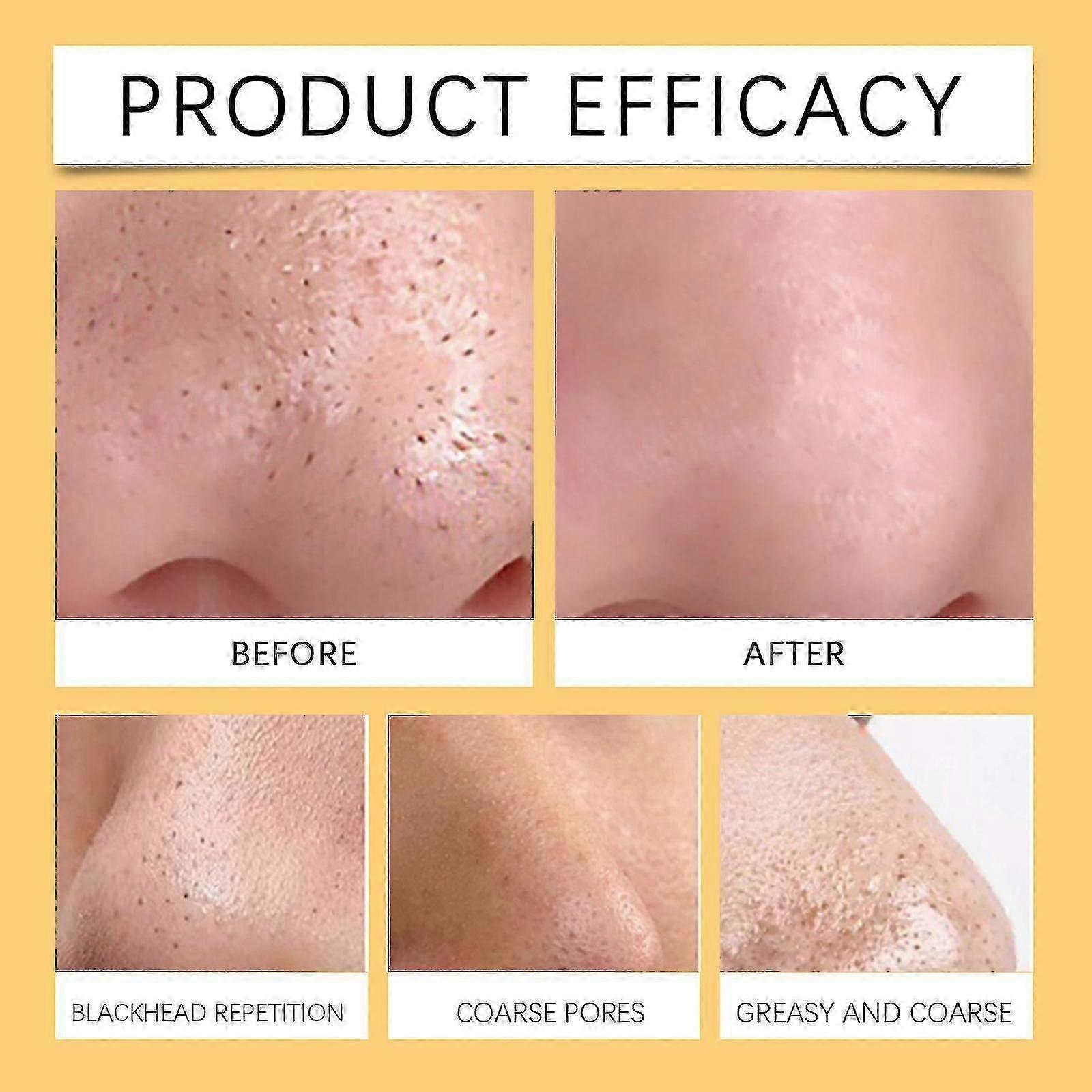 Pore Cleansing Patch, Blackhead Removal Pore Strips, Hydrocolloid Nose ...