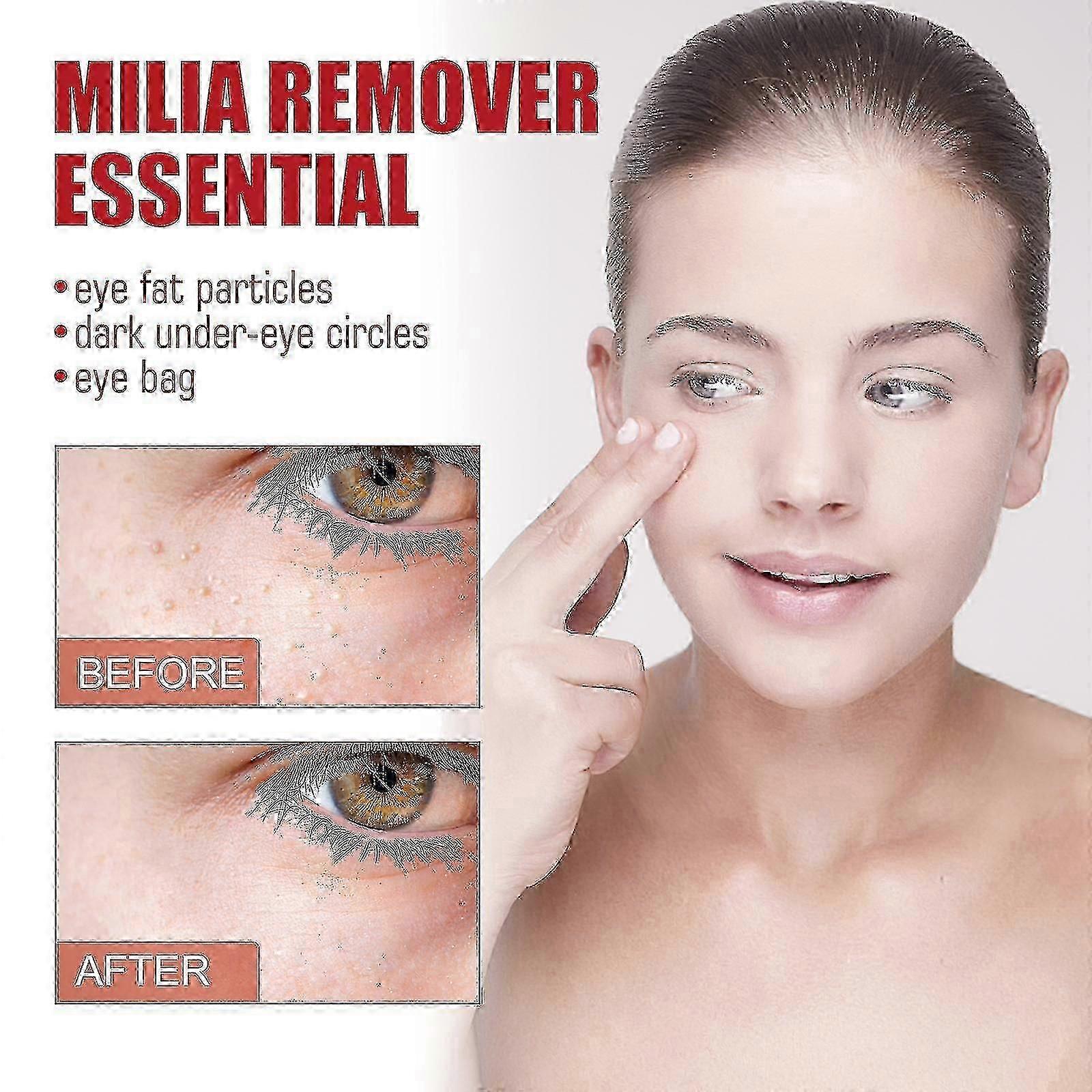 Speedy Milia Remover, Milia Remover Milia Spot Treatment, Speedy Milia ...