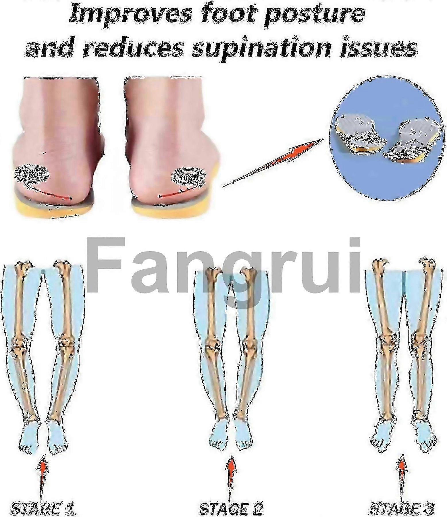 For Supination Insoles For Over Supination High Arch Supportorthotic ...