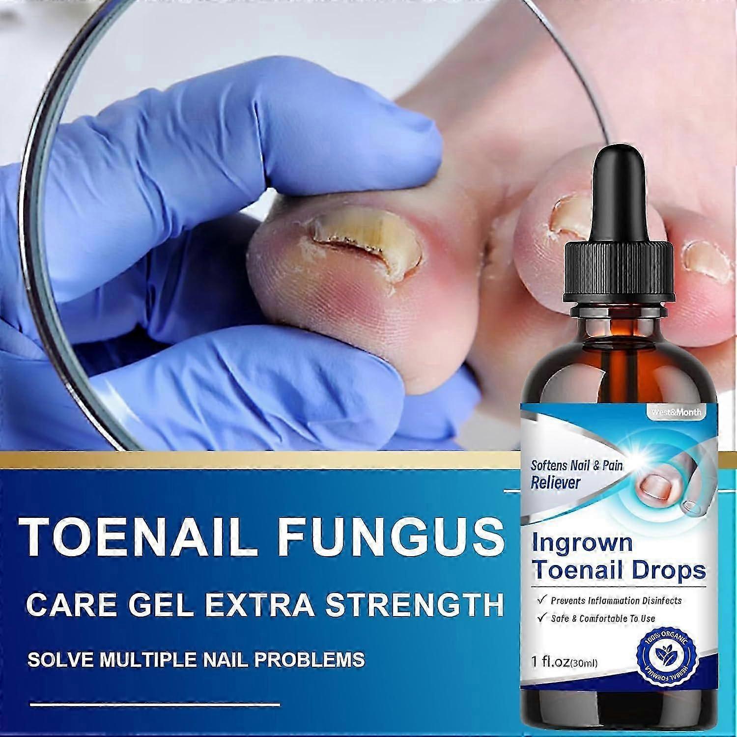Ingrown Toenail Drops, Ingrown Toenail Treatment, Cuticle Care Oil For ...