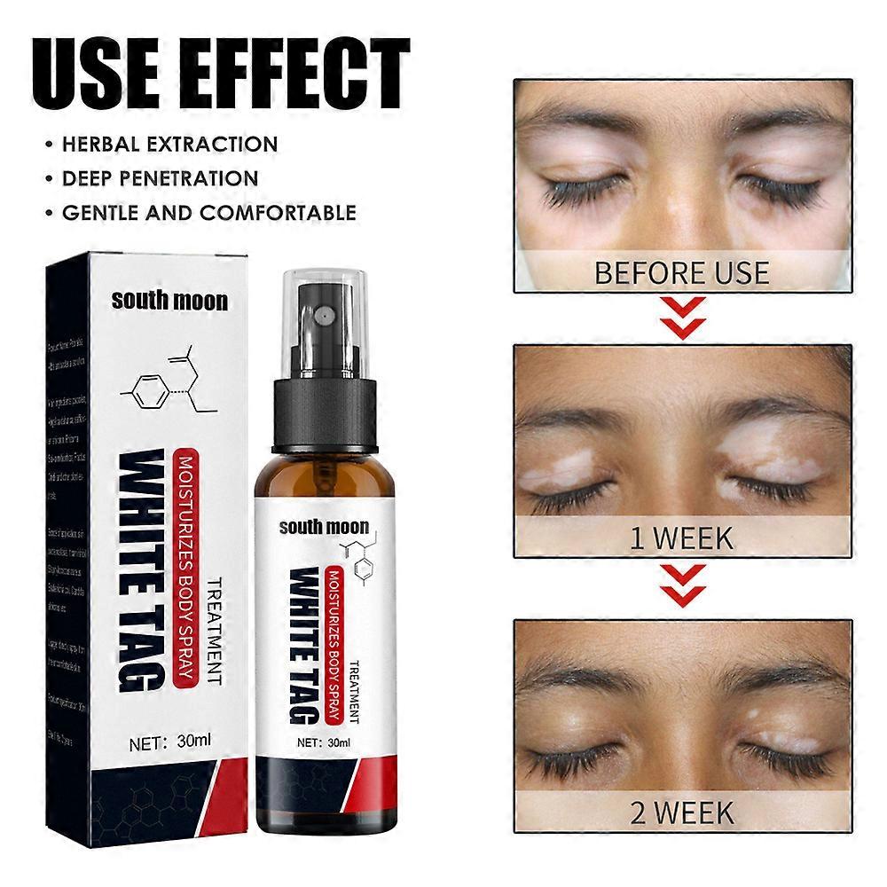 2PCS White Spot Remover Spray Herbal Antibacterial Vitiligo Treatment ...