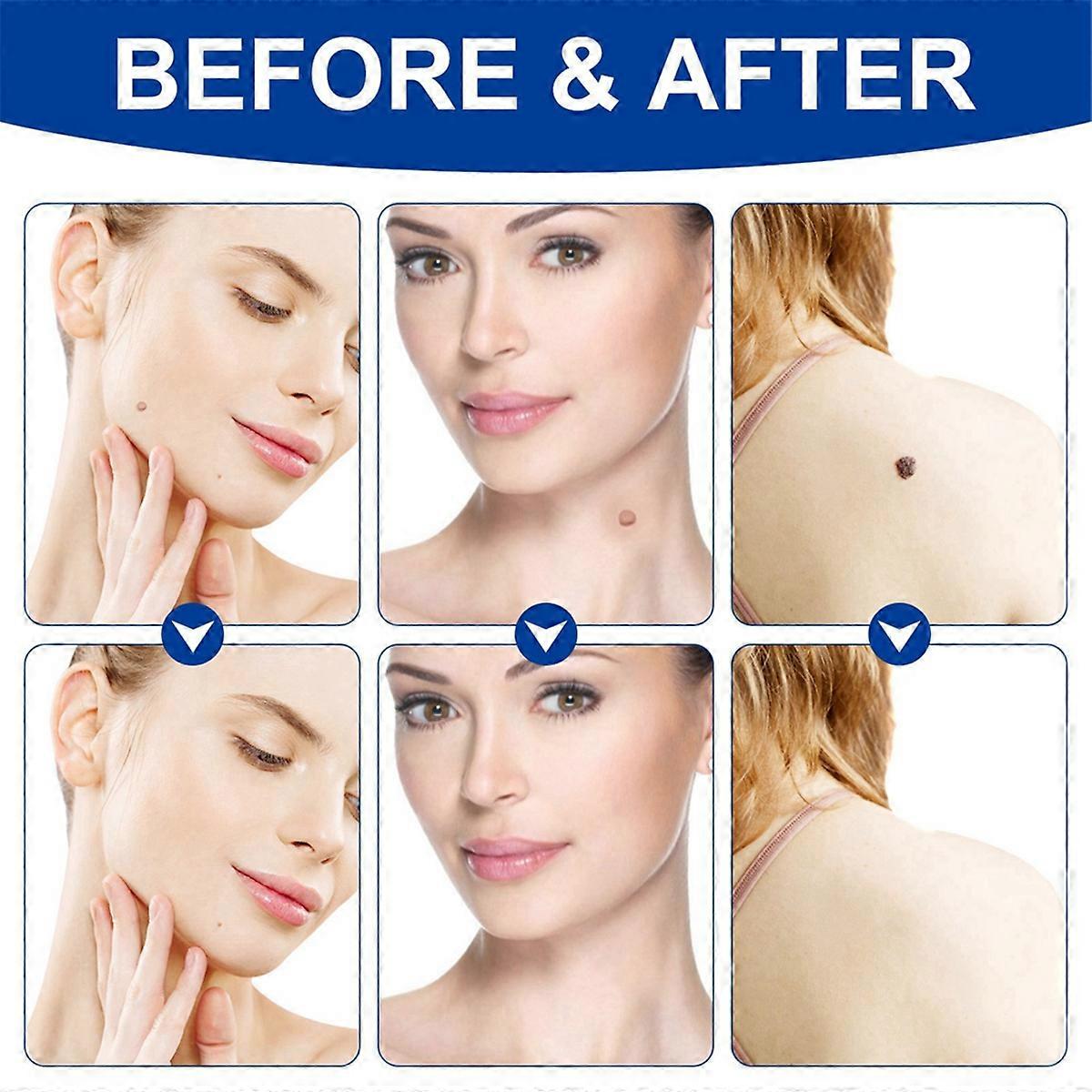 Skin Tag Removal Kit Painless Skin Tag Removal Pen Easy Skin Tag ...