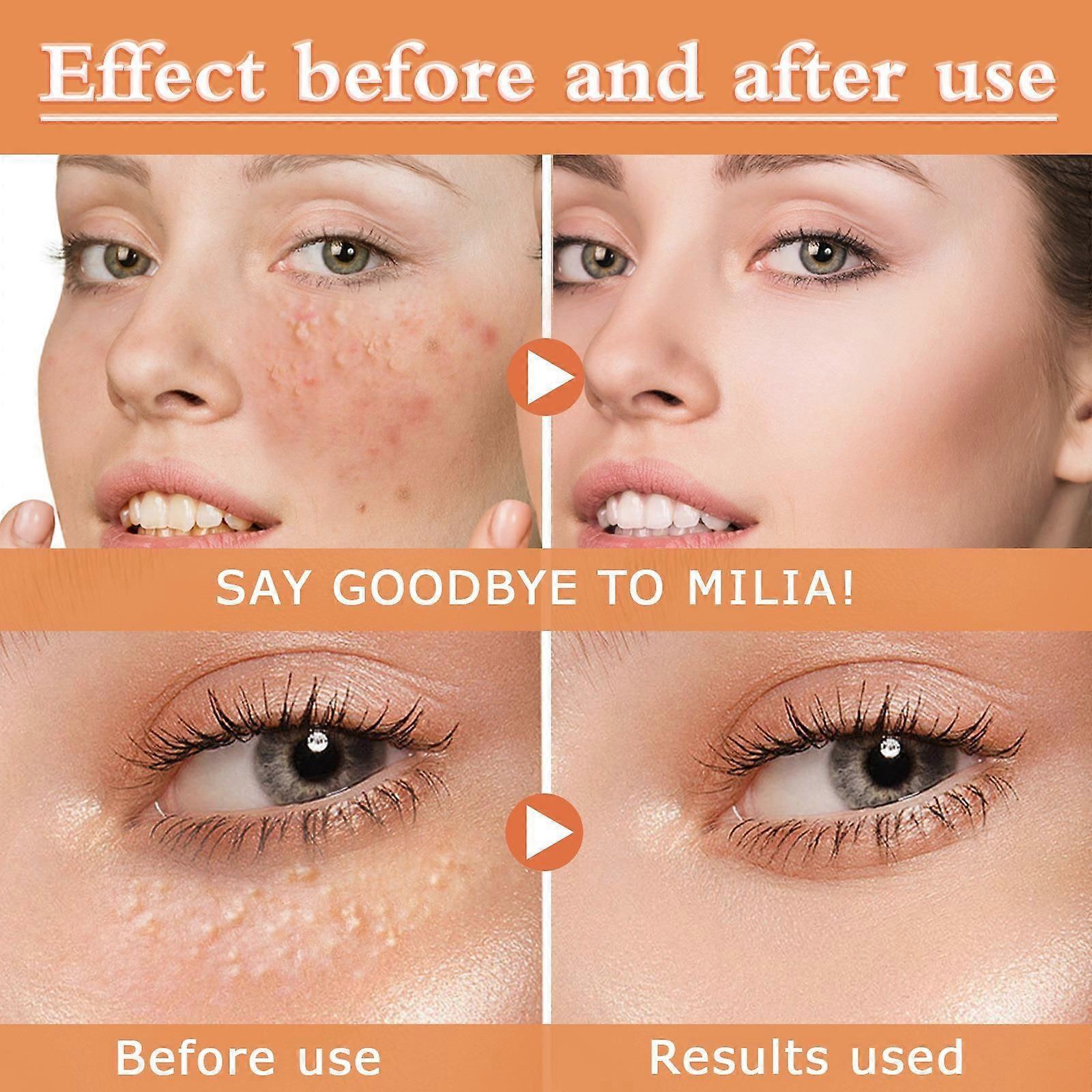 Milia Clearing Essence, Milia Remover Eye Serum, Milia Remover Milia ...
