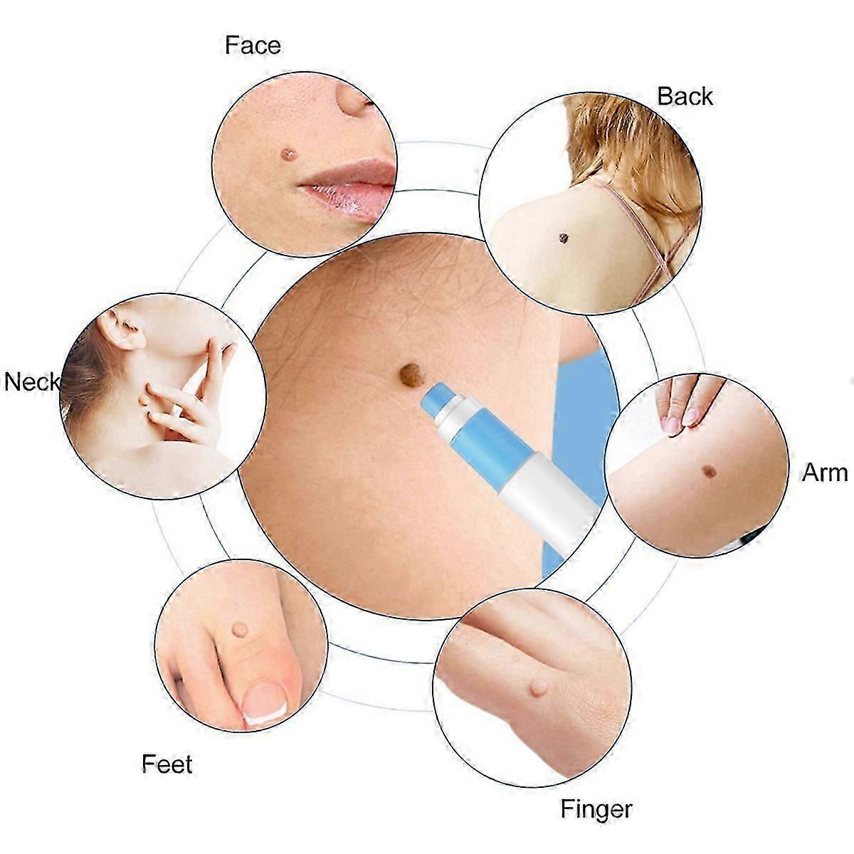 Skin Tag Removal Kit Painless Skin Tag Removal Pen Easy Skin Tag ...