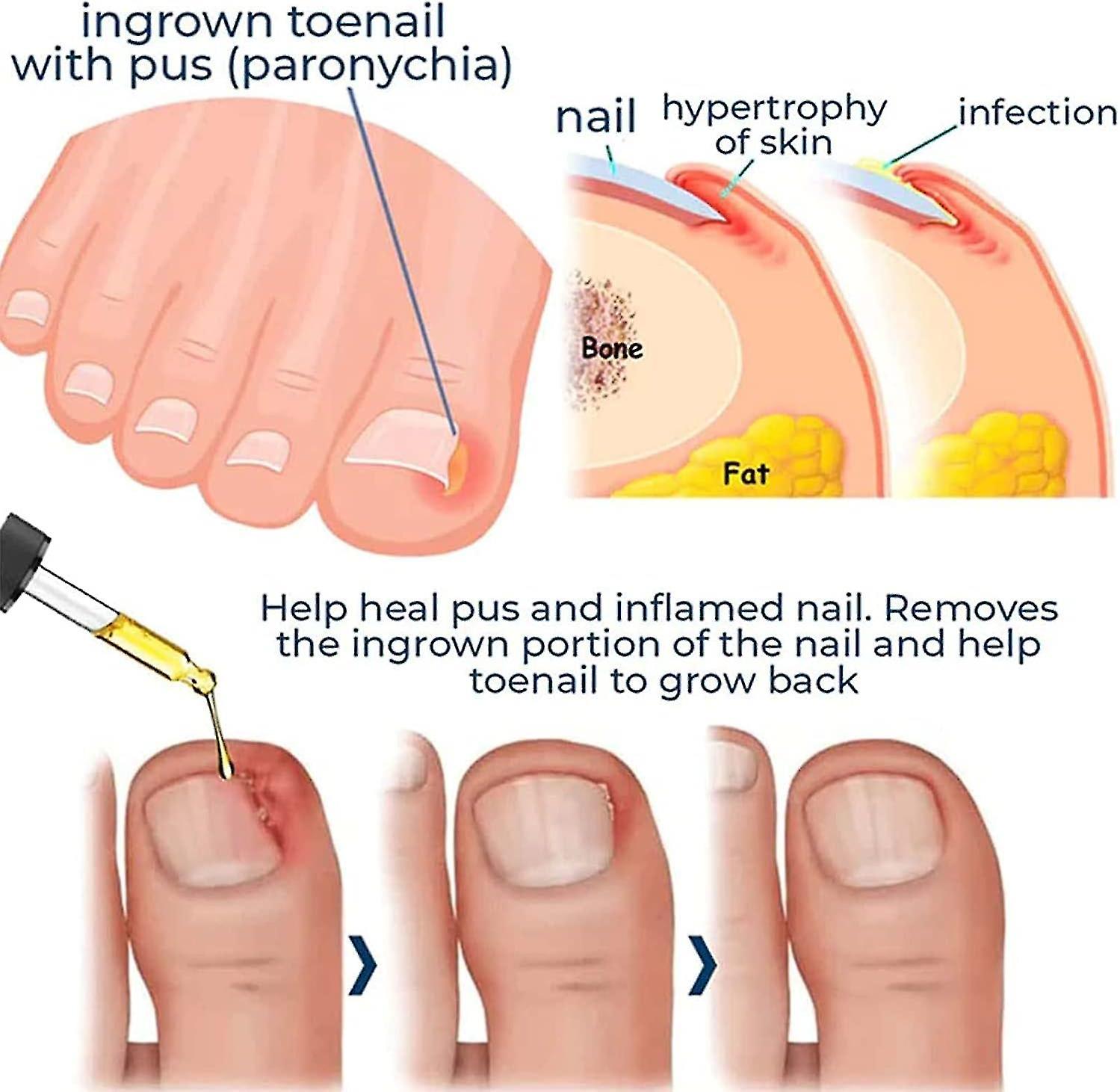 Anti Paronychia Relief Oil,2pcs Anti Paronychia Relief Oil,paronychia ...