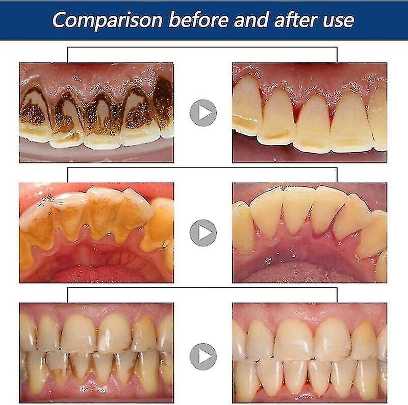 30ml Calculus Dissolving Dental Spray Oral Tooth Cleaner Tartar Remover ...