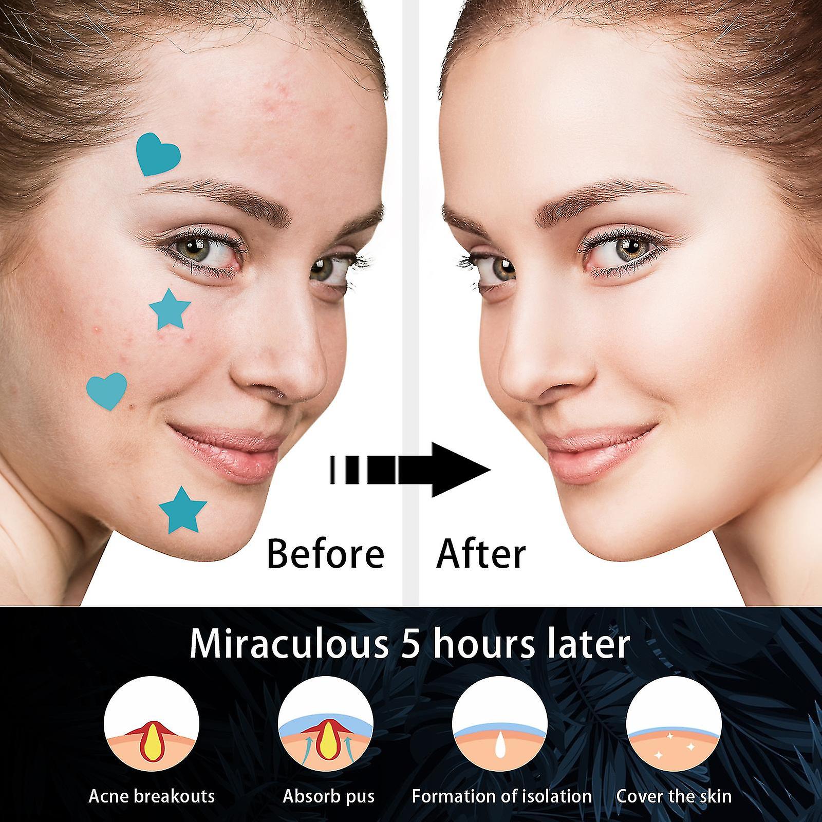 216pcs Pimple Patches, Invisible Natural Hydrocolloid Skin Tag Cover ...