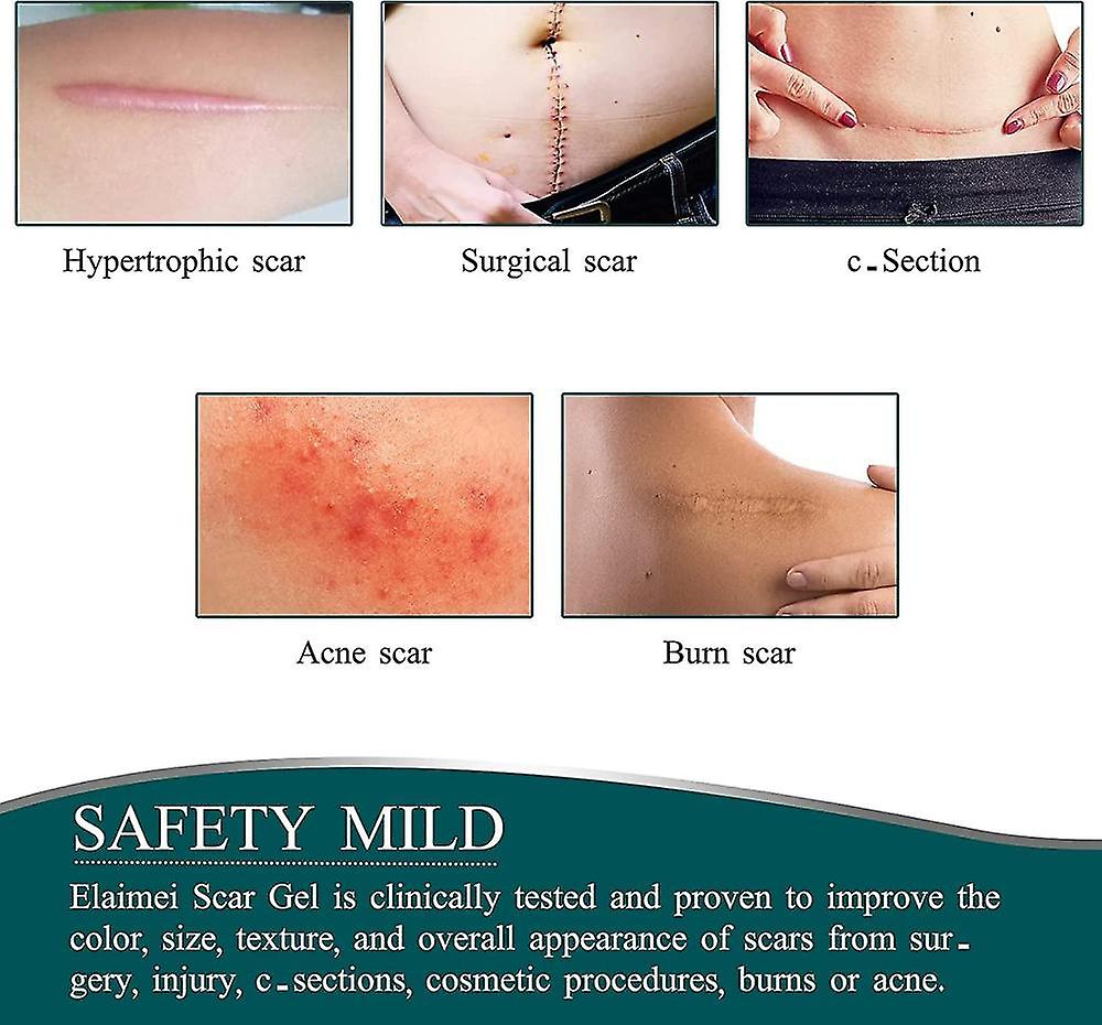 Silicone Plasters For Scars, Silicone Scar Films For Surgeries ...