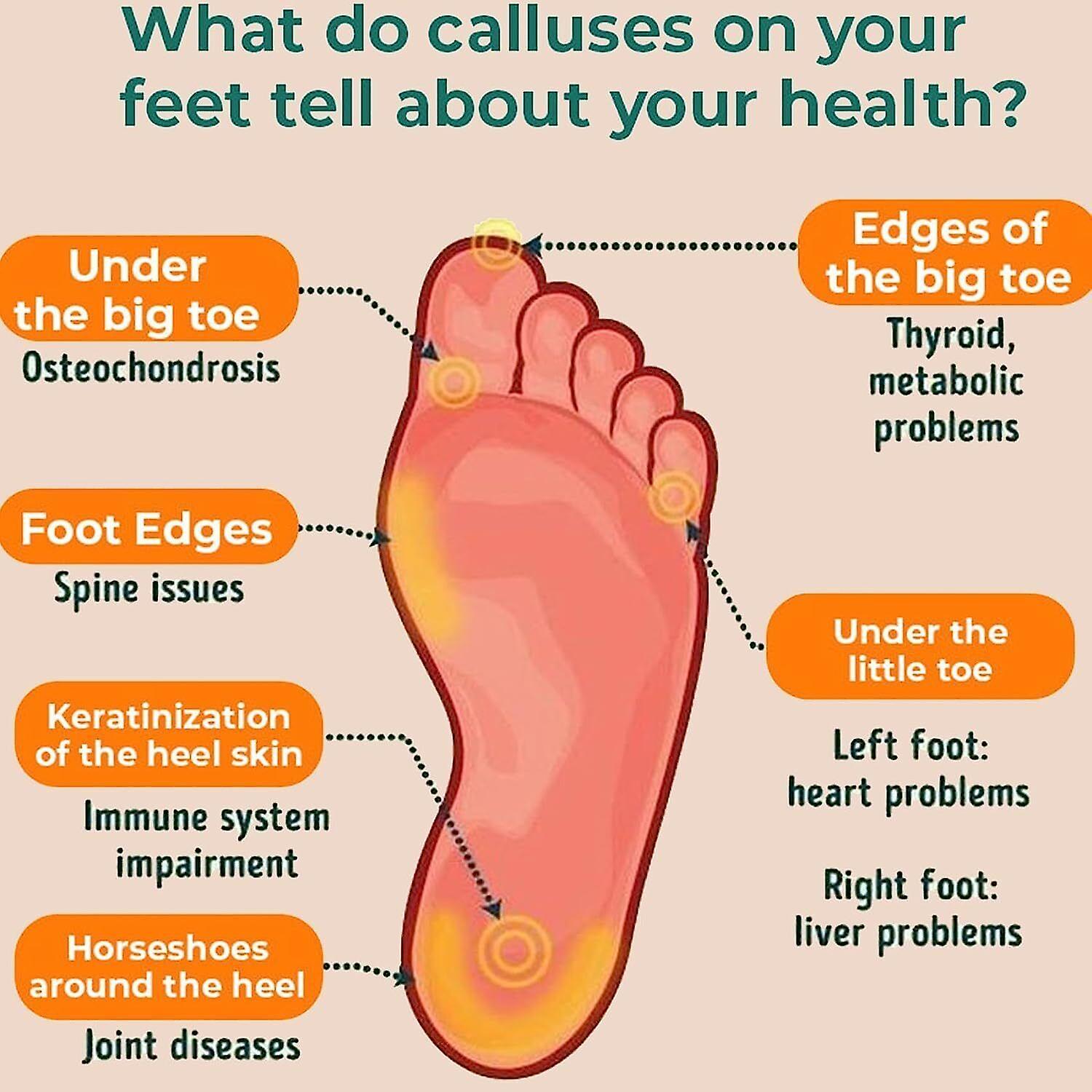 Foot Callus Removal Spray, Foot Heel Callus Remover Spray, Foot Peel ...