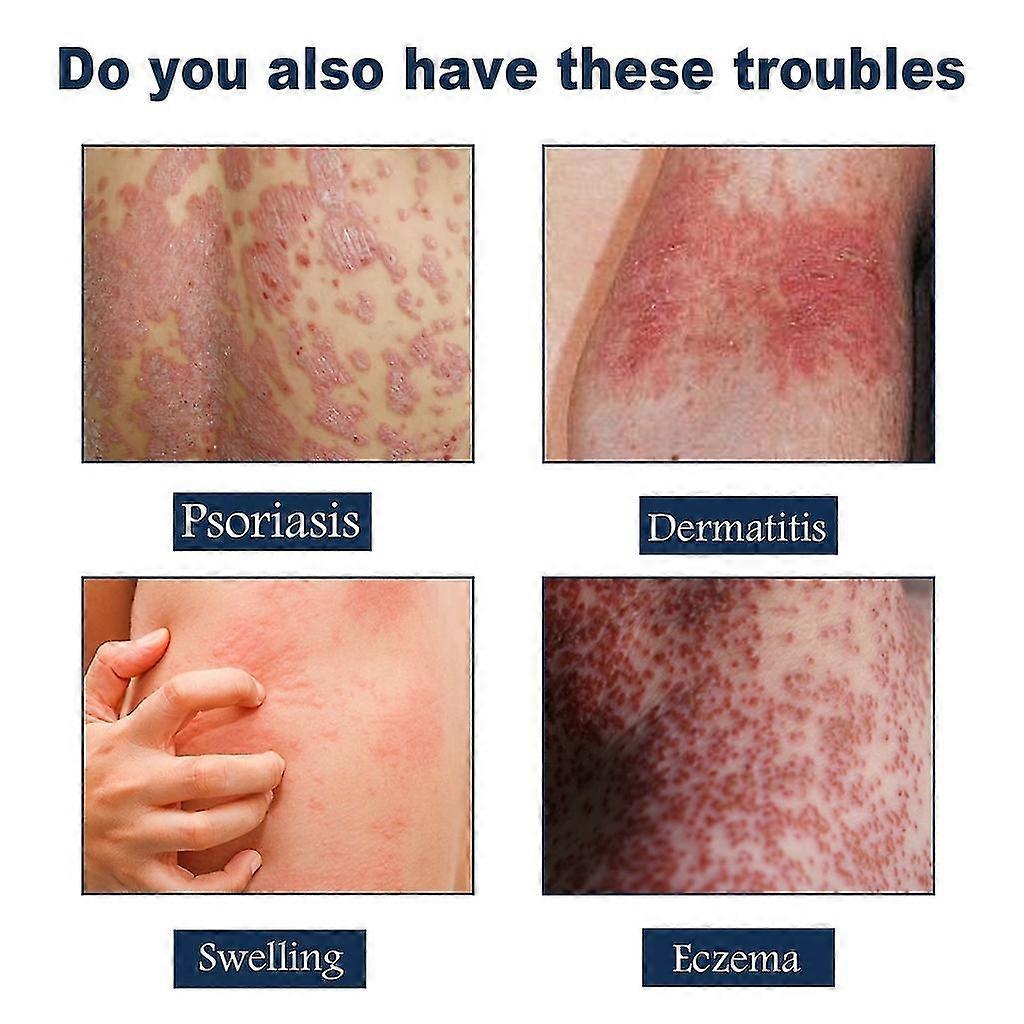 30ml Psoriasis Treatment Spray Hand Foot Scalp Eczema Tinea Anti-itch ...