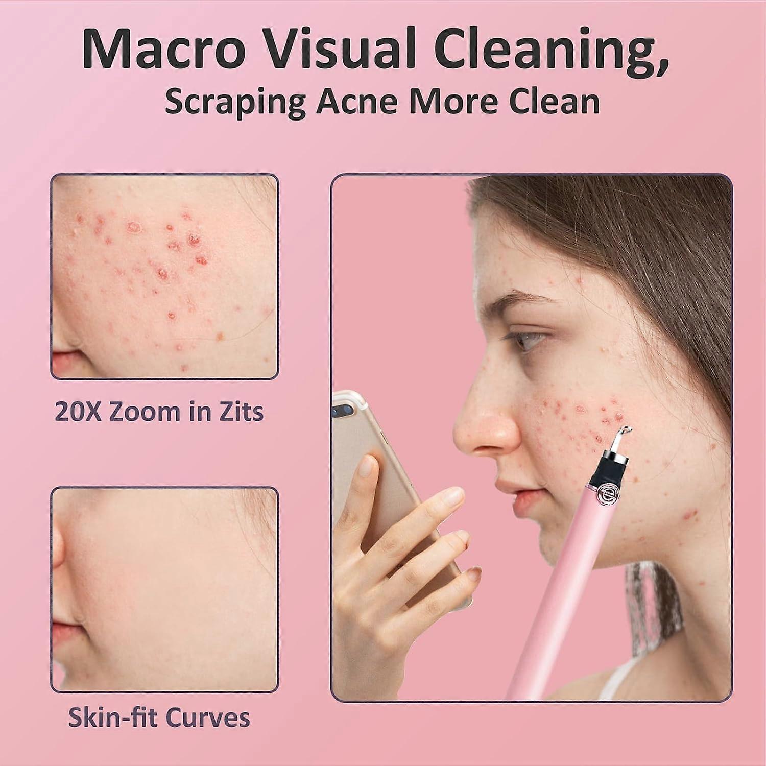 Visible Blackhead Remover, Advanced Pimple Popper with 20X Camera ...