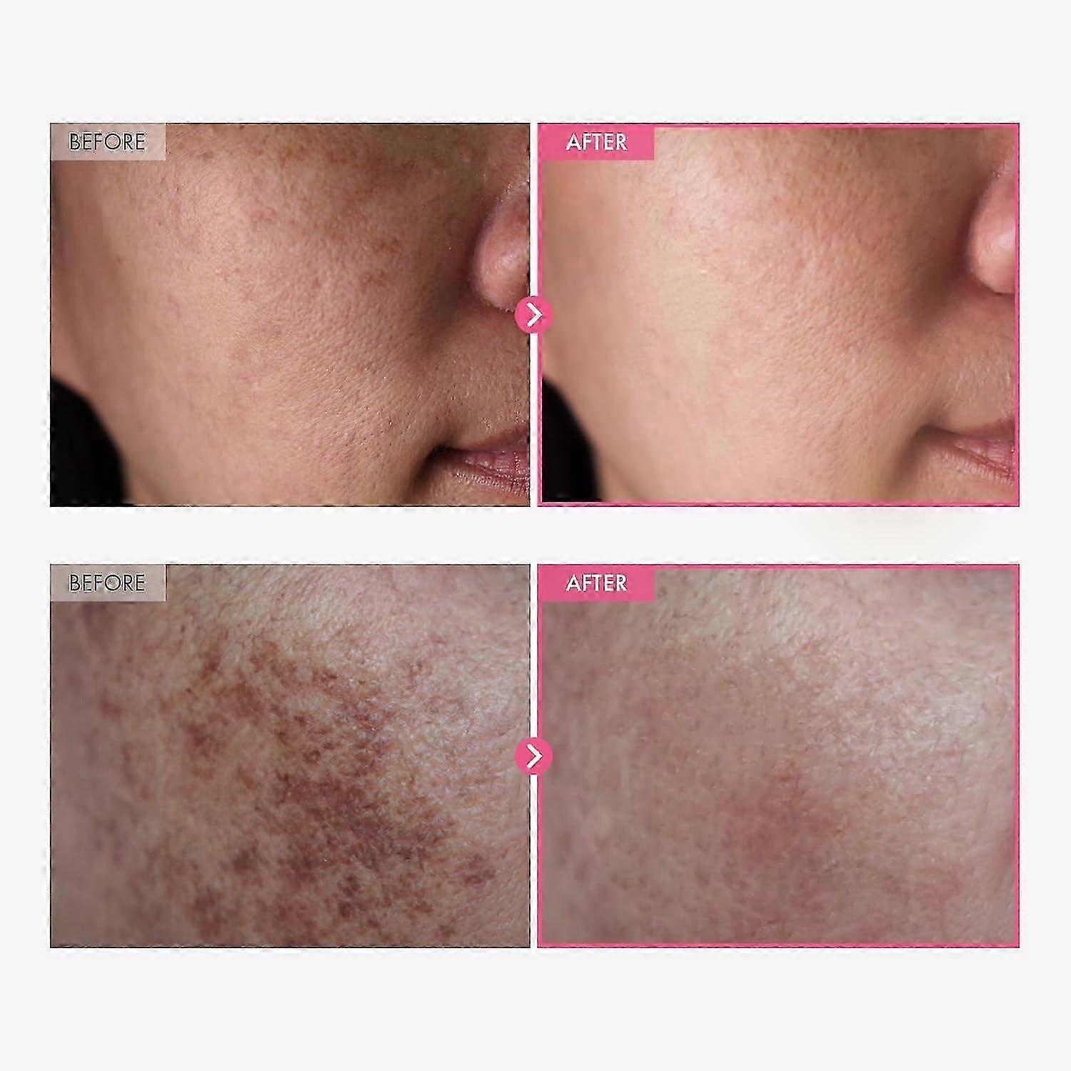 2026-1-5x Arbutin 7% + Tranexamic Acid 4% Cream 50g | Fruugo UK