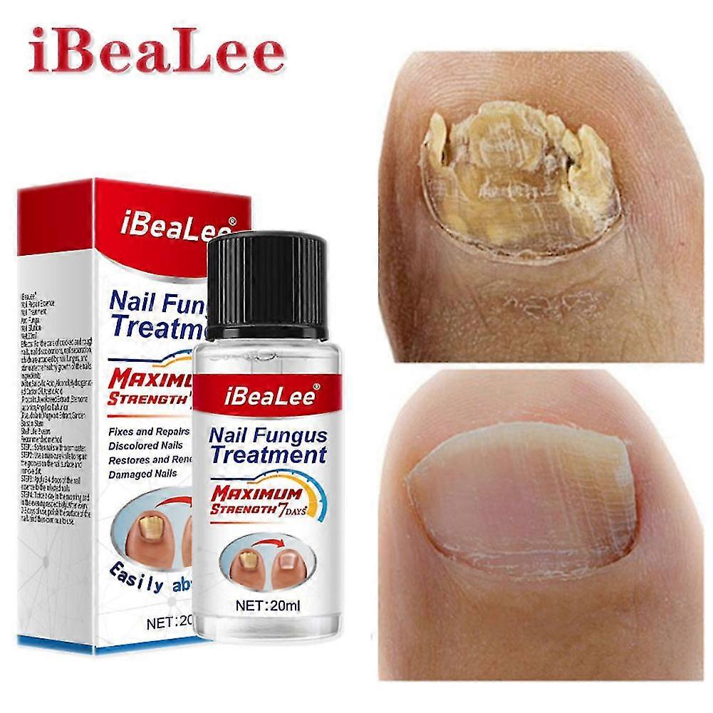 Nail Fungal Treatment Feet Care Essence Anti Infection Paronychia ...