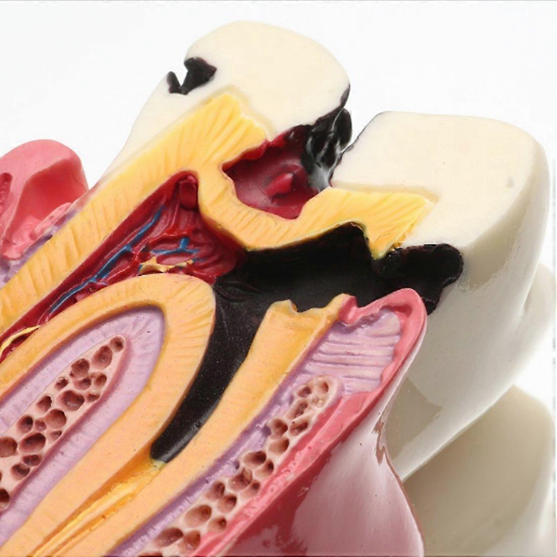 Dental Caries Tooth Model, YOUYA DENTAL Decay Teeth Comparative Study ...