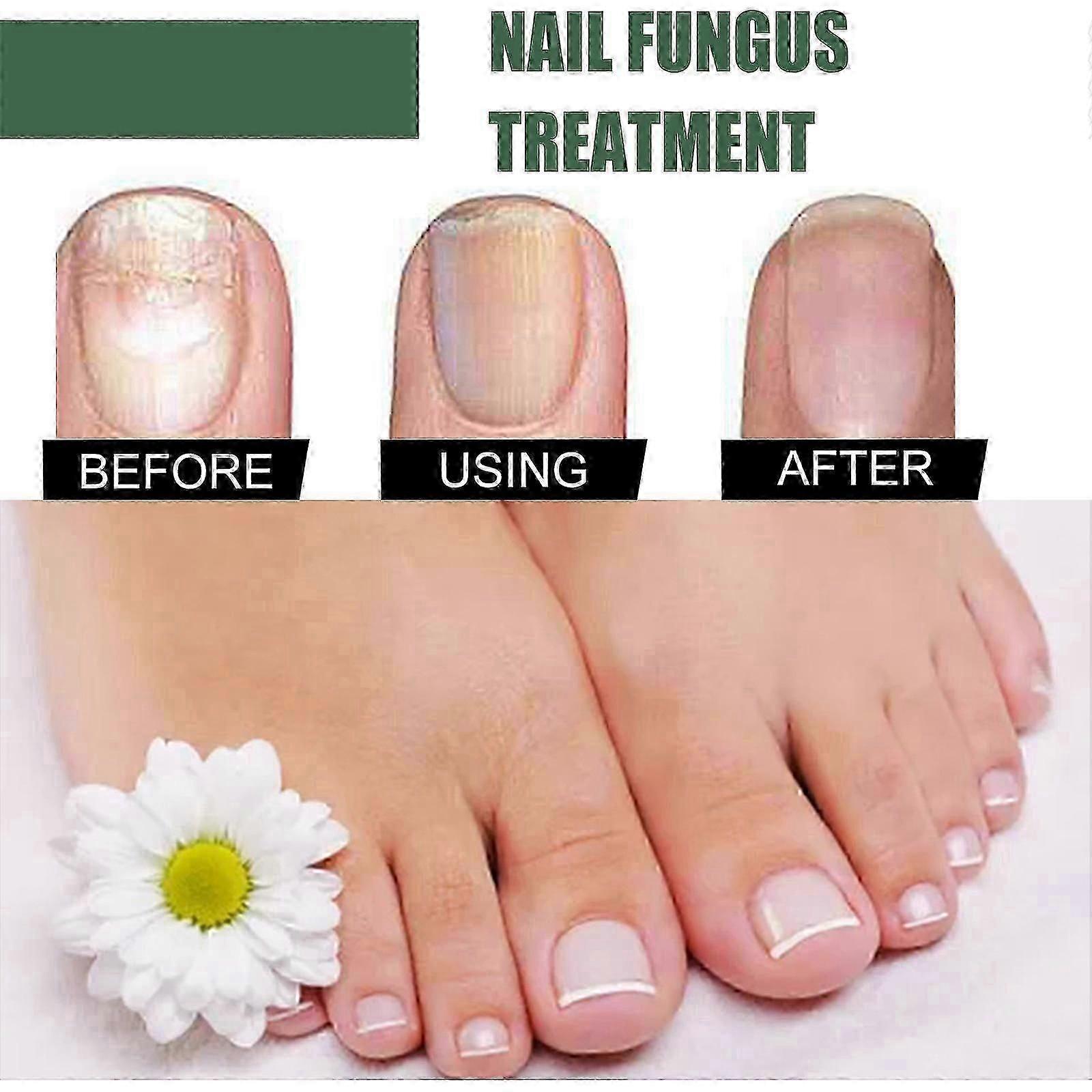 Extra Strong Nail Fungus Treatment, Best Nail Repair Stops Fungus ...