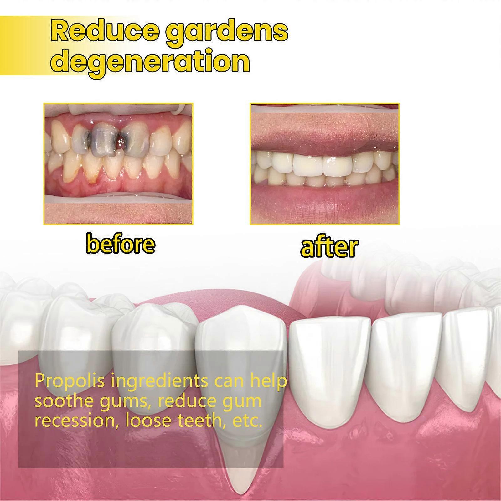 Propolis Gum Care Gel, Propolis Oral Gum Repair Gel, Propolis Teeth ...