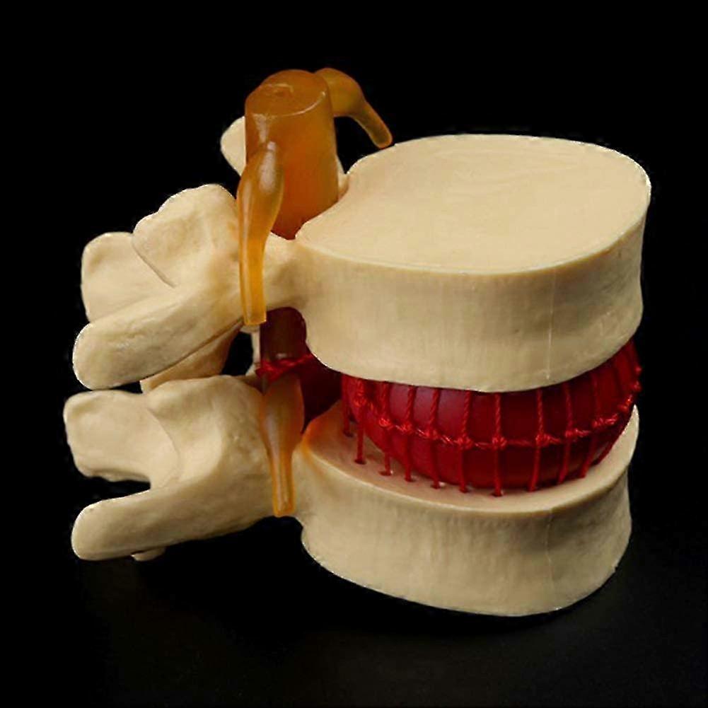 Lumbar Vertebrae Model Anatomical Spine Lumbar Disc Herniation Anatomy ...