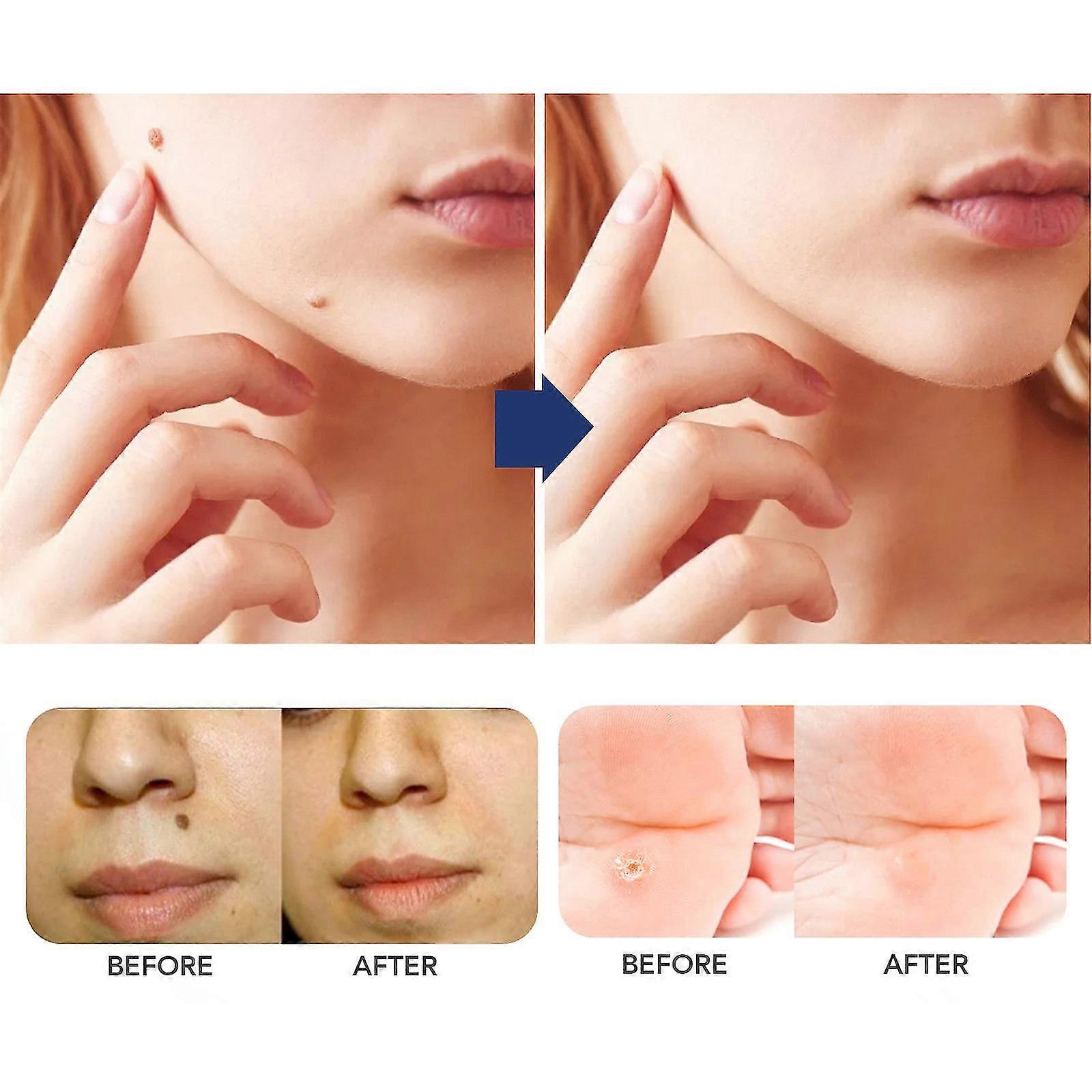 2pcs Skin Tag Remover Super Strong Skin Tag Remover Serum Made From ...