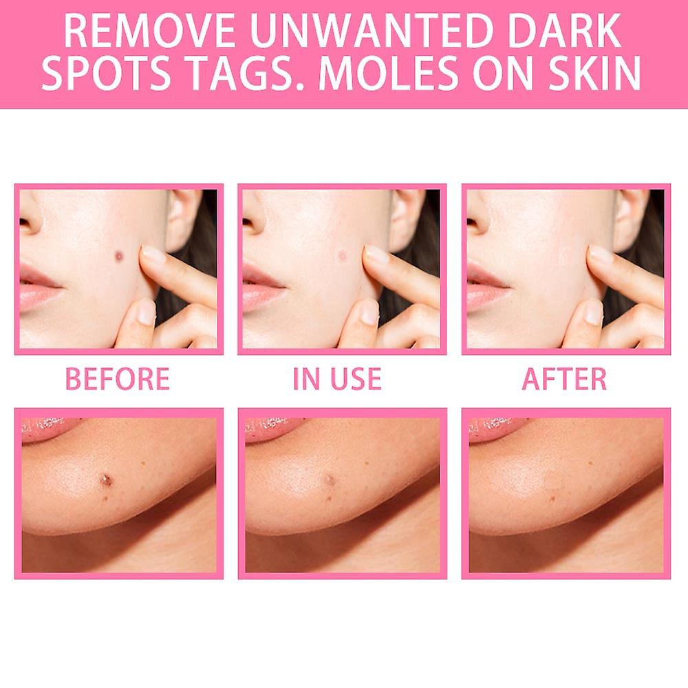 Traceless Nevus Potion Remove Nevus Essence Repair Nevus Dark Spots ...