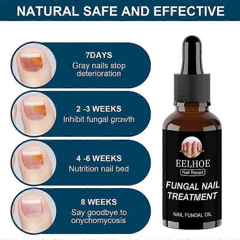 Fast Fungal Nail Treatments Serum Onychomycosis Paronychia Anti-Fungal ...