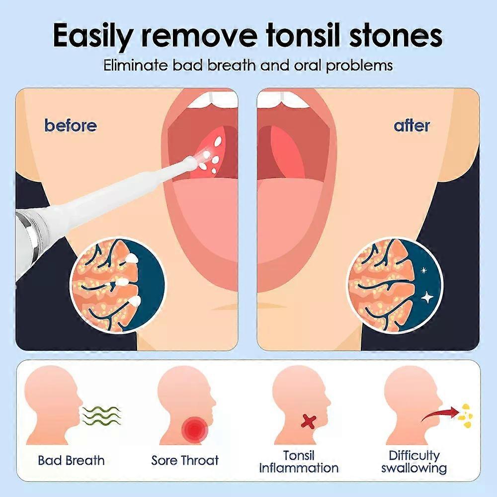 SElectric Tonsil Stone Remover Tonsil Stone Removal Kit Vacuum With ...