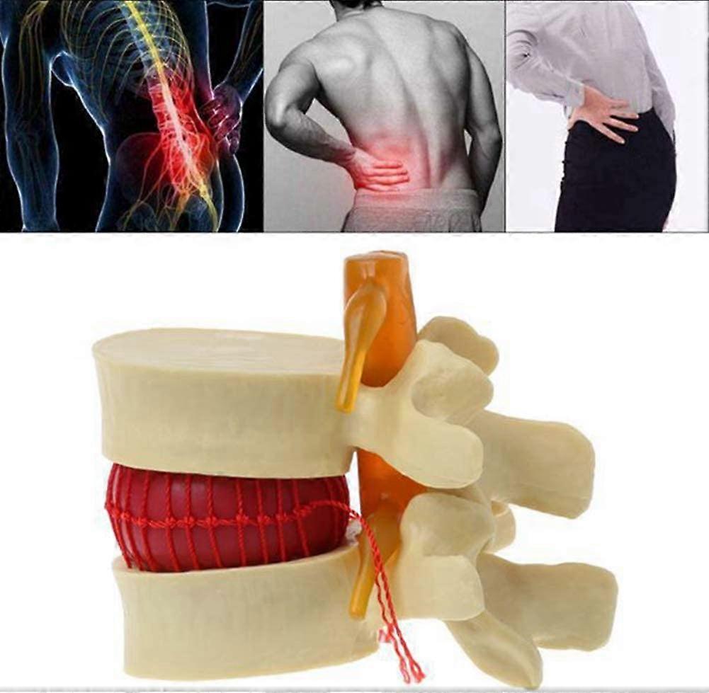 Lumbar Vertebrae Model Anatomical Spine Lumbar Disc Herniation Anatomy ...