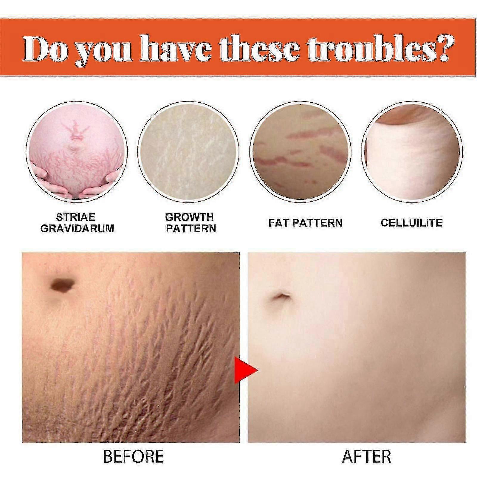2x Stretch Marks Removal Cream Fat Growth Streaks Maternity Scars Acne ...