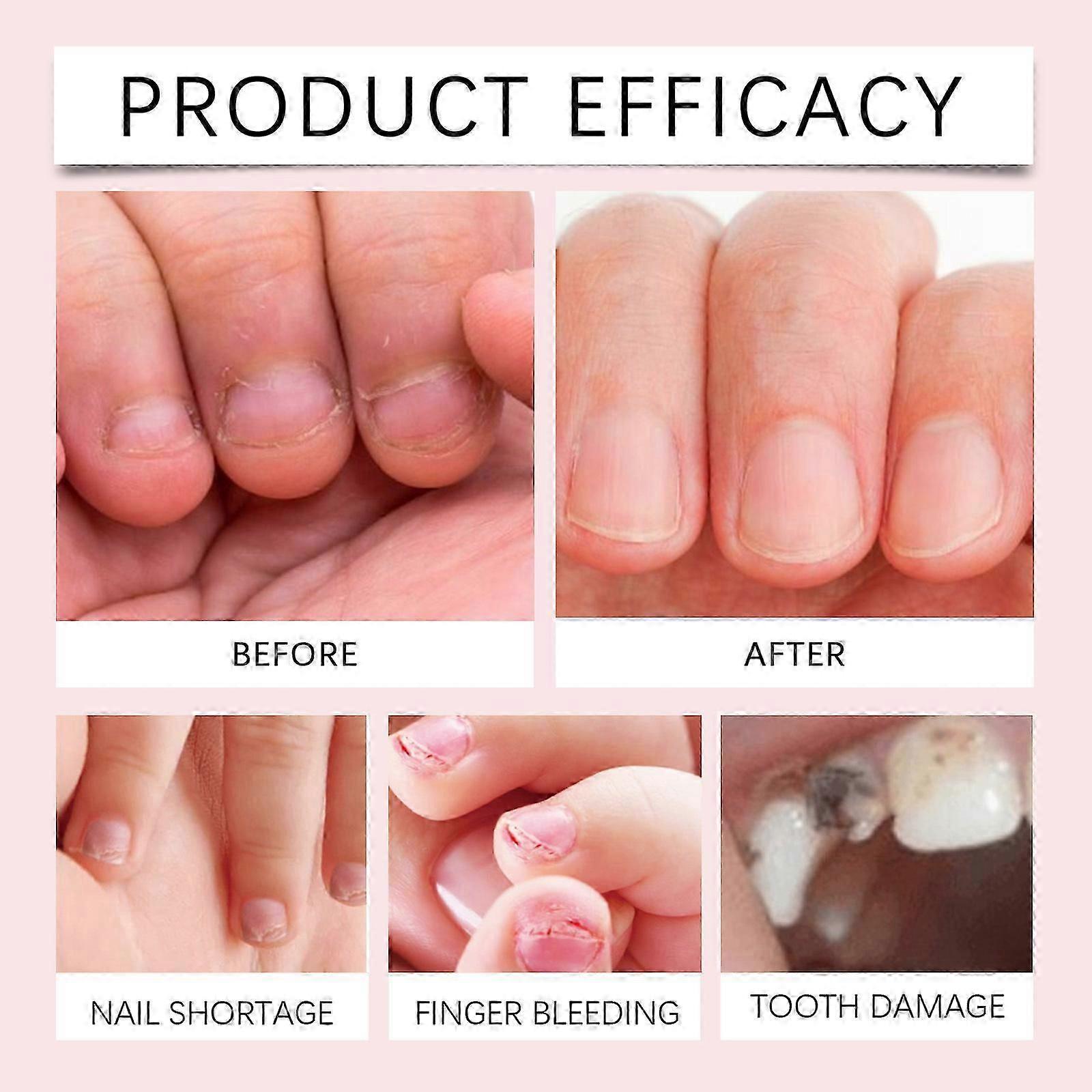 Nail Biting Treatment For Kids - Nail Biting Treatment for Kids ...