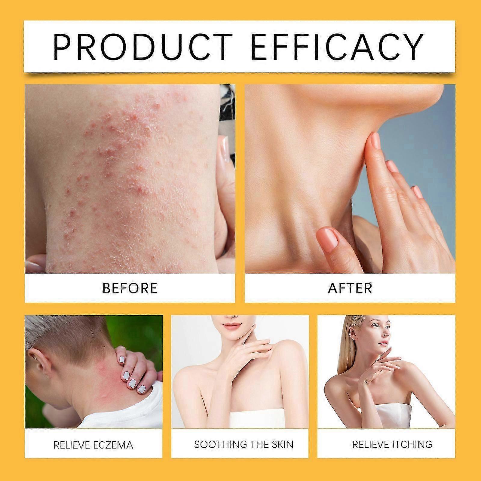 Eczema Treatment Cream, Skin Relief Anti-itch Cream, Bee-Venom Cream ...