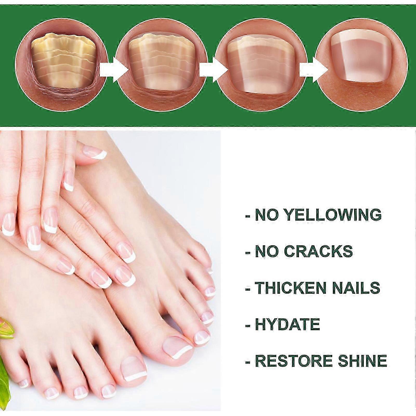 7days Ginger Nail Care Serum,Nail Fungus Treatment, Moisturize the ...