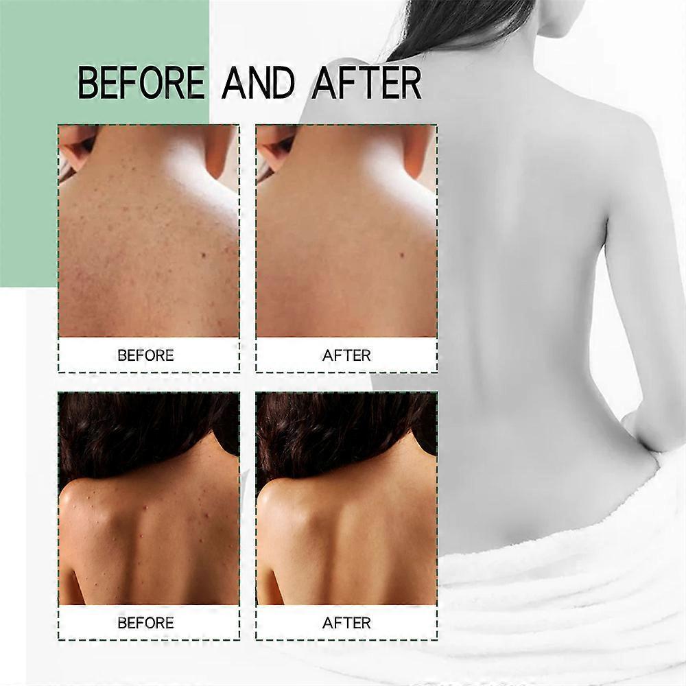 3pcs Back Acne Repair Spray Fades Pockmarks Repair Back Back Shoulder ...