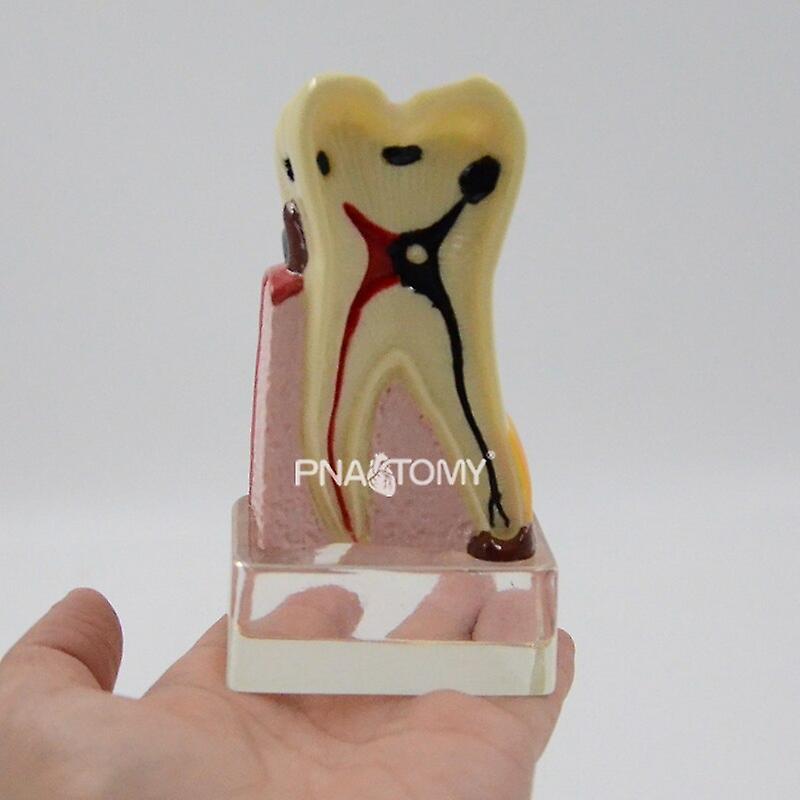 Enlarged Diseased Teeth Model Saprodontia Decayed Tooth Dental Nerve ...