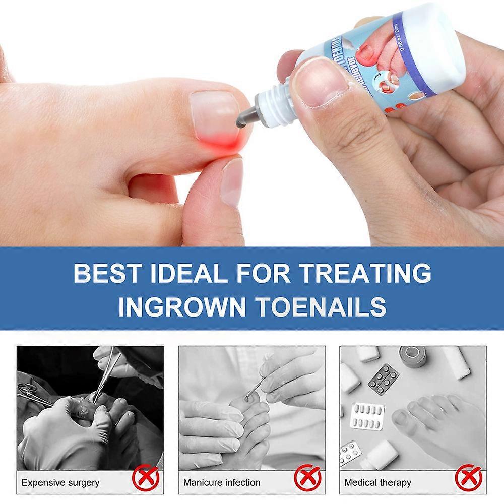 Ingrown Toenail Drop- Cuticle Care Oil for Ingrown Toenails - Trimming ...