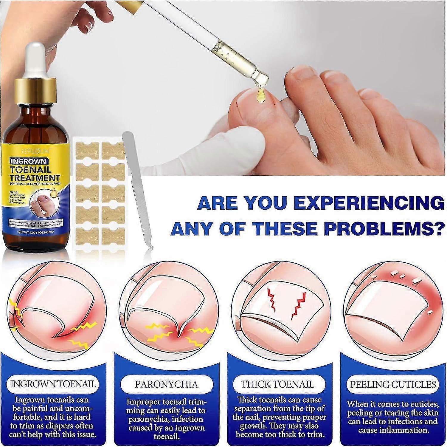 Ingrown Toenail Treatment 60ml, Softener Ingrown Toenail for Easy ...