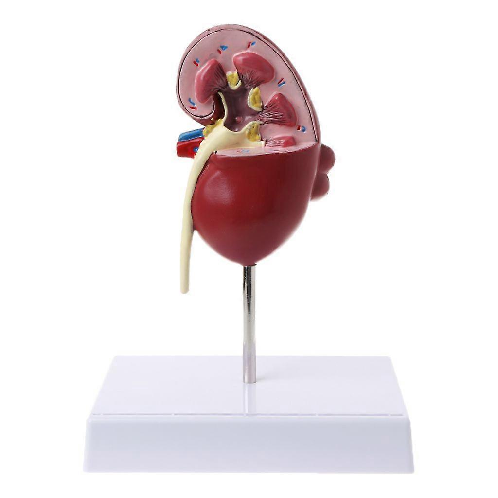 Life Size Human Kidney Diseased Model Anatomical Anatomy Diseased ...