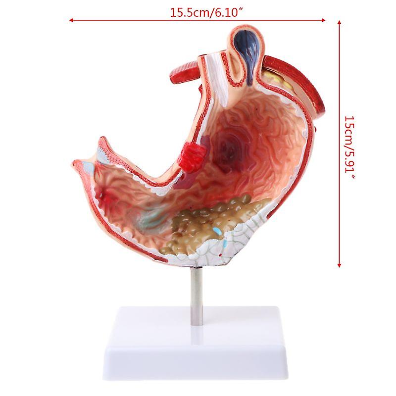 Human Anatomical Anatomy Stomach Model Gastric Pathology Gastritis ...