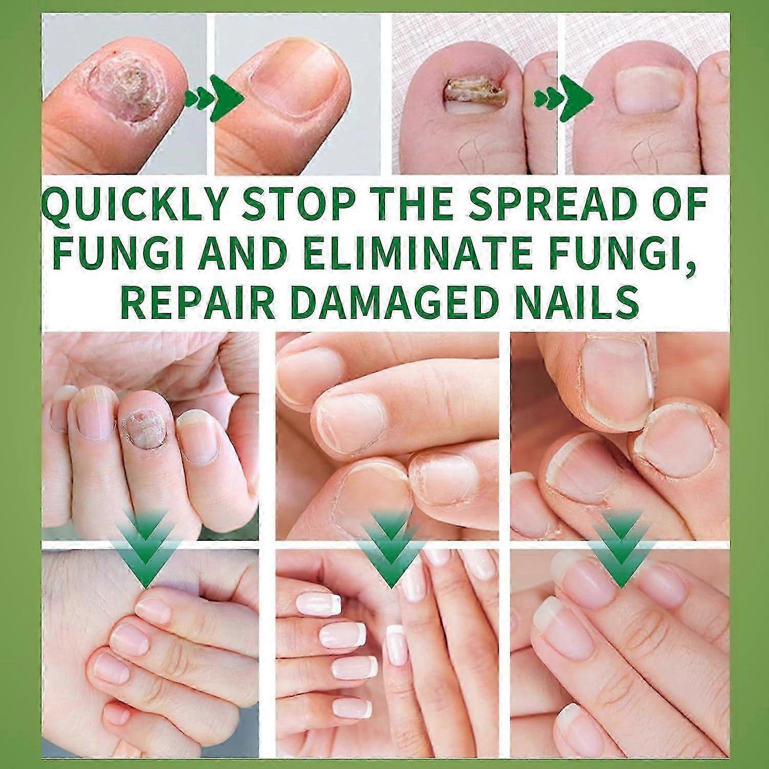 Ginger Nail Fungus Treatment Extra Strength, Anti Fungal Nail Treatment ...