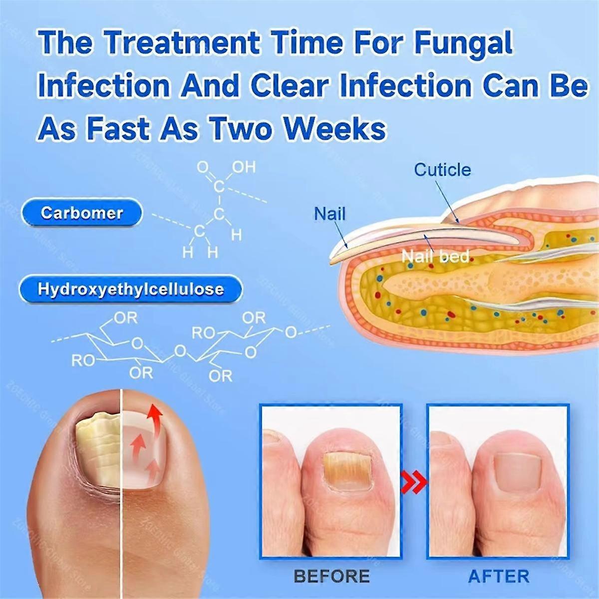 Nail Laser Treatment Device Fingernail Treat Onychomycosis Effectively ...