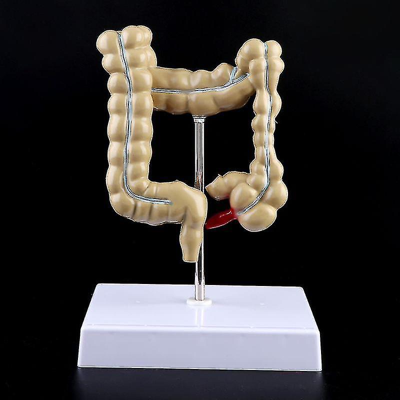 Human Colorectal Lesion Model Pathological Anatomy Colon Diseases ...