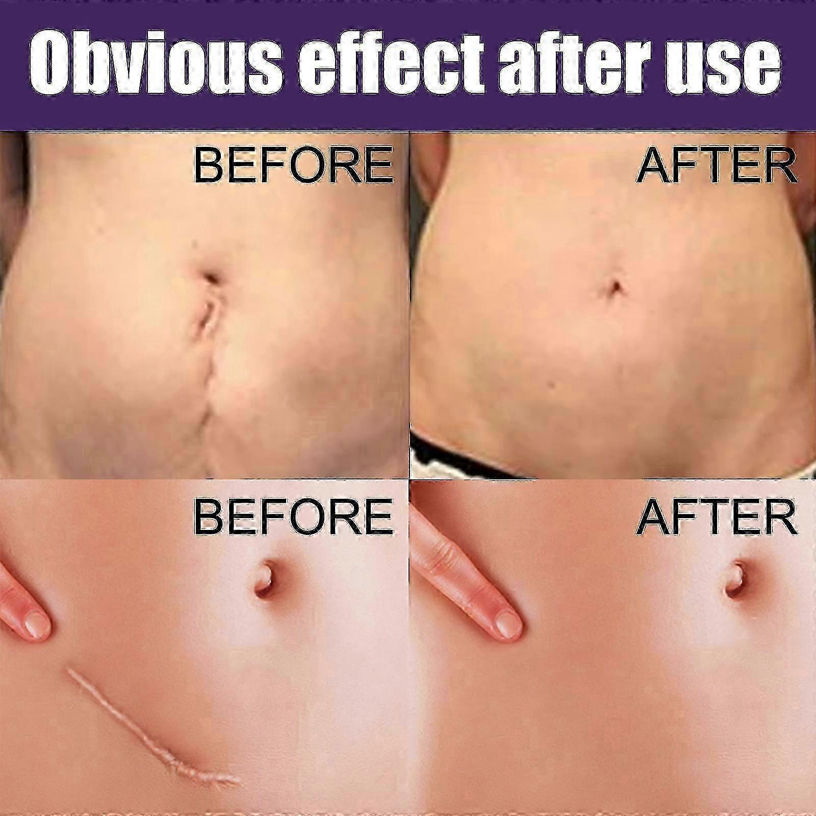 Silicone Scar Stickers Dilute Scars Caesarean Section Surgery Scar ...