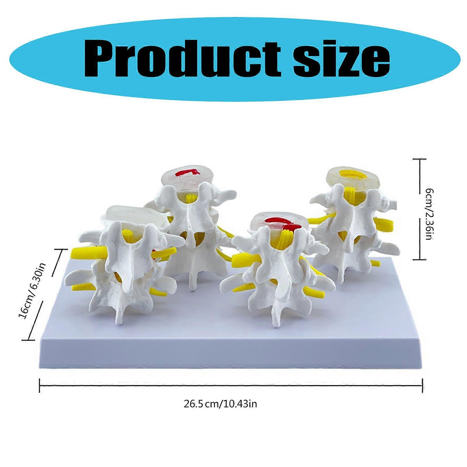 Human Skeleton Model for Anatomy Lumbar Spine 4 Stages Lesions ...