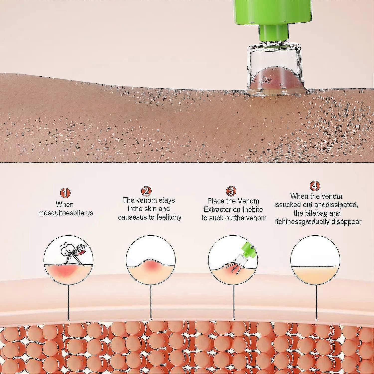 Bites Relief Suction Tool, Vacuum Venom Extractor For Mosquito Bee ...