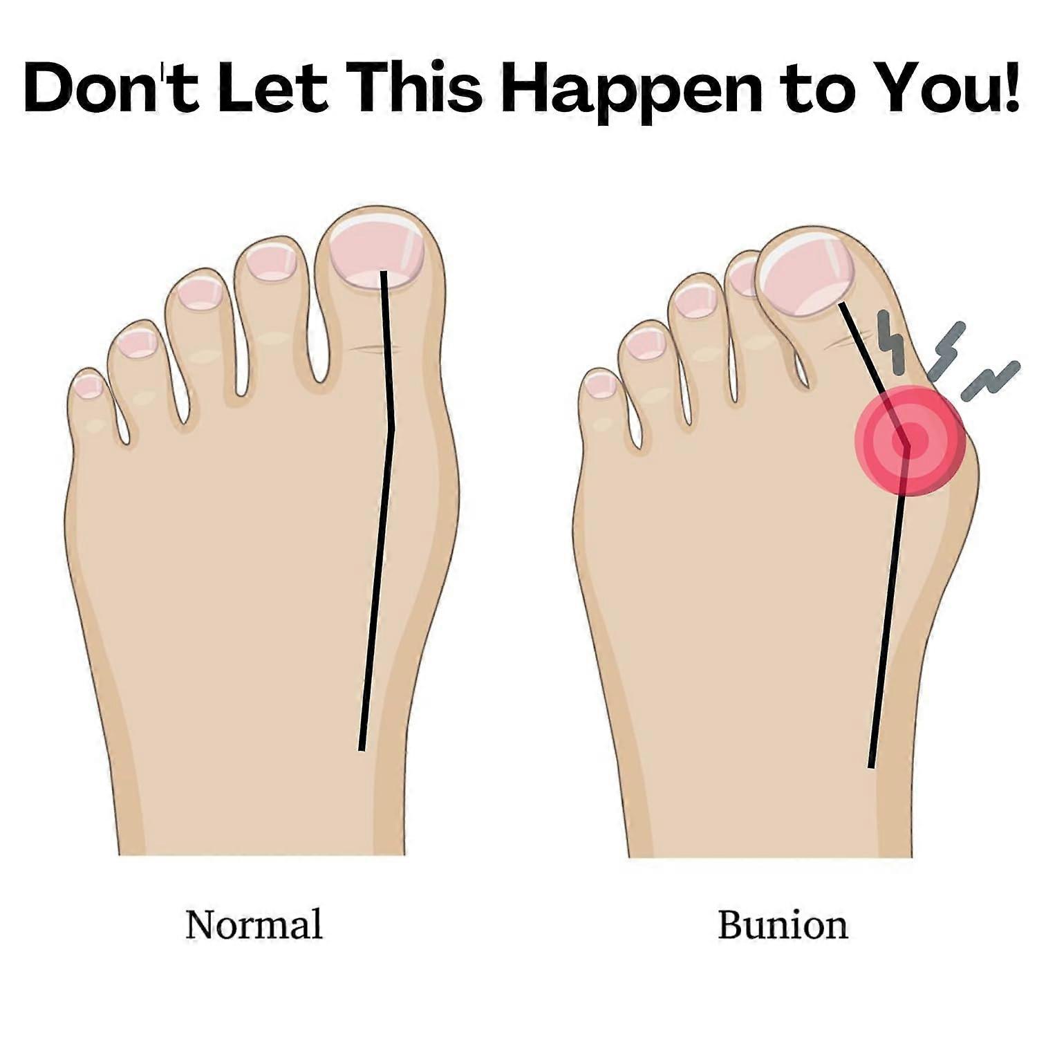 Toe Separators for Hammertoes and Bunions - Small Foot Alignment ...