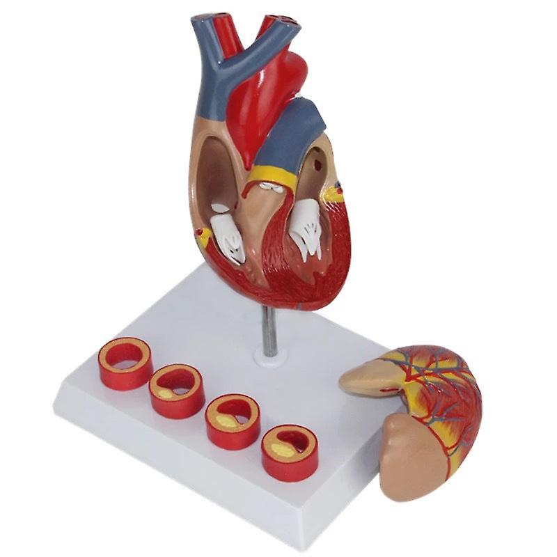 Kx-a401 Heart Model 4-stage Vascular Artery Pathological Stage Cardiac ...