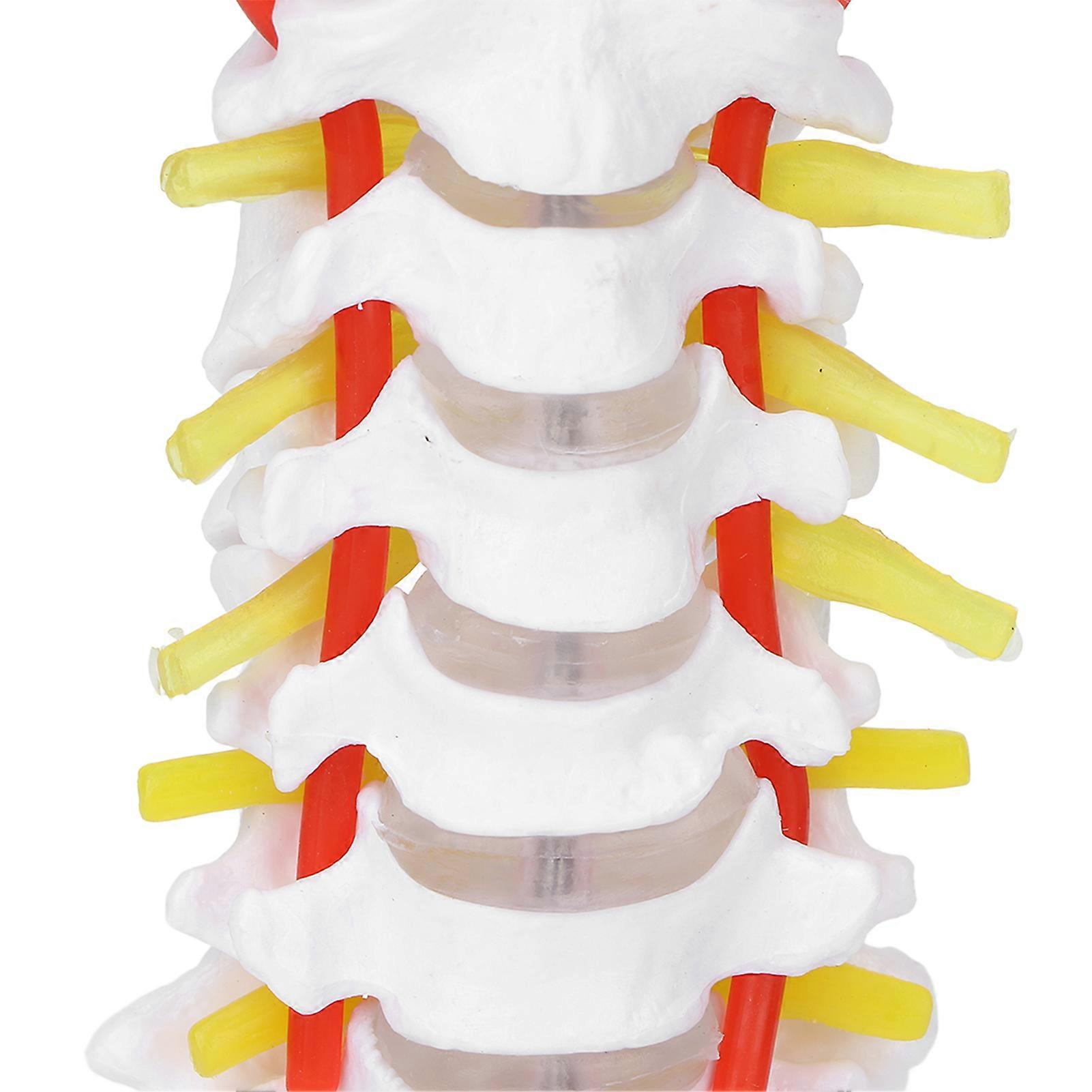 Vertebra Model Lumbar Intervertebral Disc Spine Model Extrusion ...