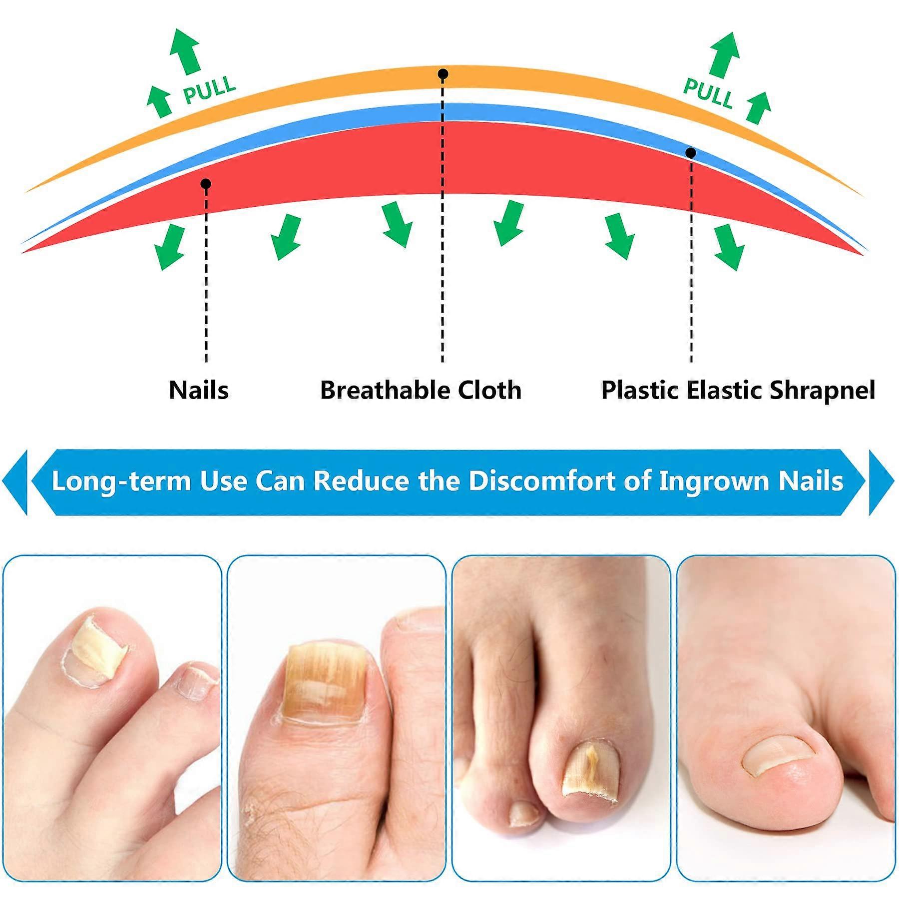 100 Pieces Ingrown Toenail Tool Set with 2 Corner Lifters, Foot Care ...